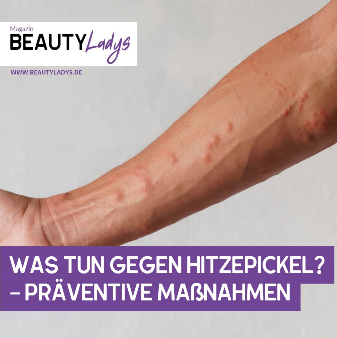 Was tun gegen Hitzepickel? 5 Tipps | Hitzeausschlag