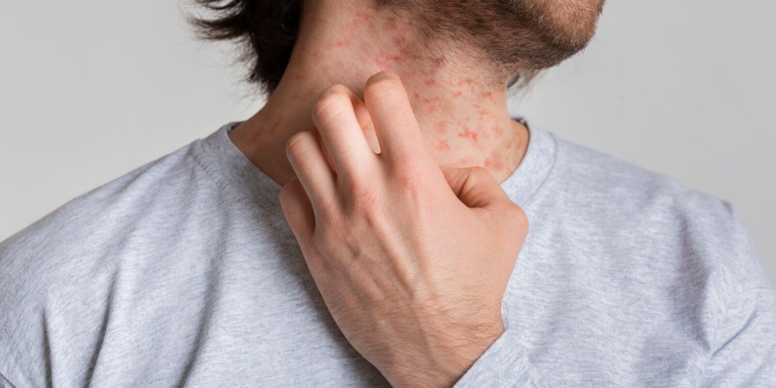 Was tun gegen Hitzepickel? 5 Tipps | Hitzeausschlag