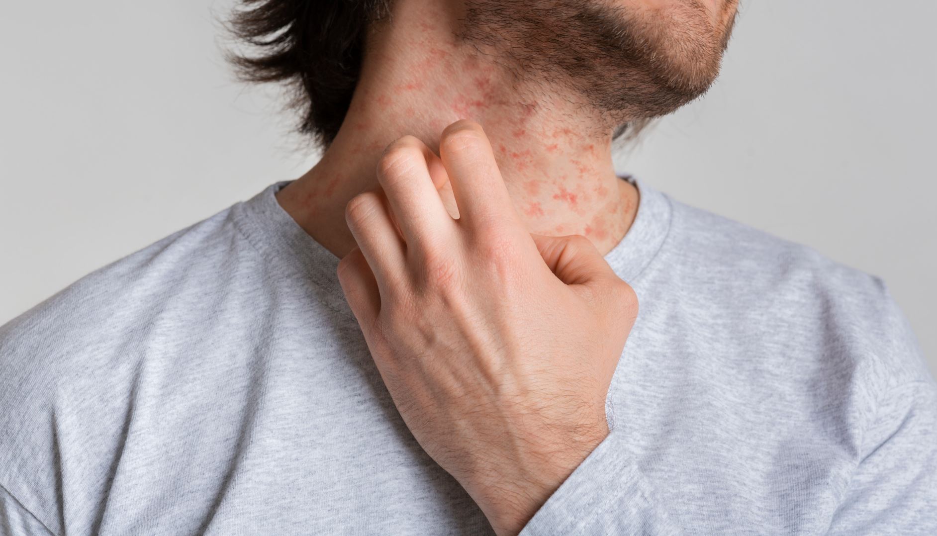 Was tun gegen Hitzepickel? 5 Tipps | Hitzeausschlag